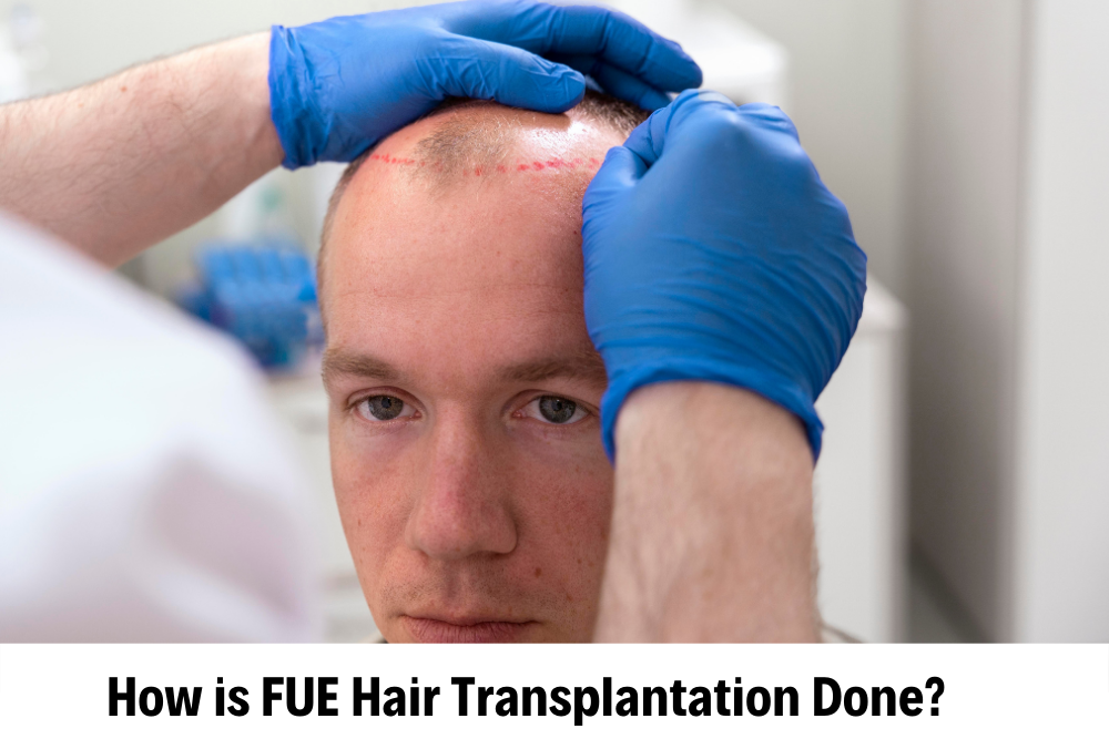 Sapphire Fue Hair Transplantation - Unisa Health Turkey